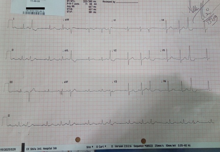 A 76 year old male with cough and wheeze having feeling of skipped ...